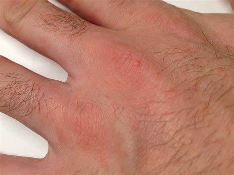 Scabies Rash Pattern