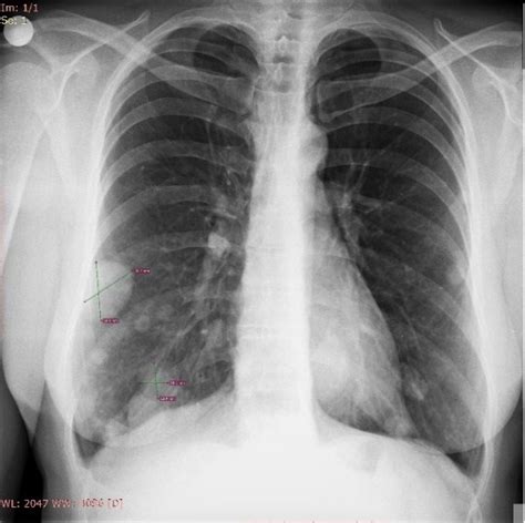 Chest X Ray Multiple Opaque Nodular Lesions Download Scientific Diagram