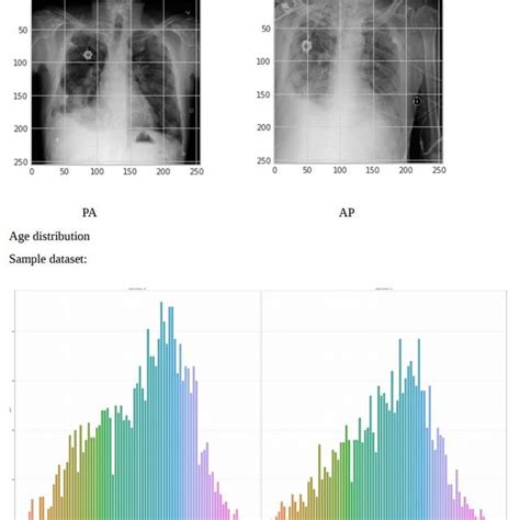 Pdf Lung Disease Detection Using Deep Learning