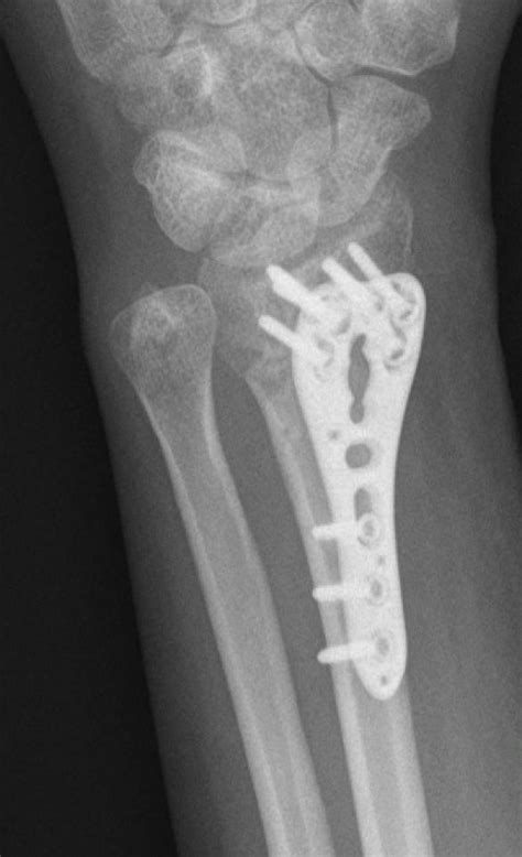 Variax 2 Distal Radius Locking Plate System Implants Orthobullets