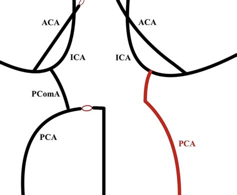 Fenestration Of The Anterior And Posterior Cerebral Arteries In