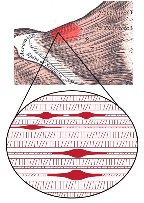 Met Techniques On Trigger Point Formation El Paso Tx Sciatica Pain
