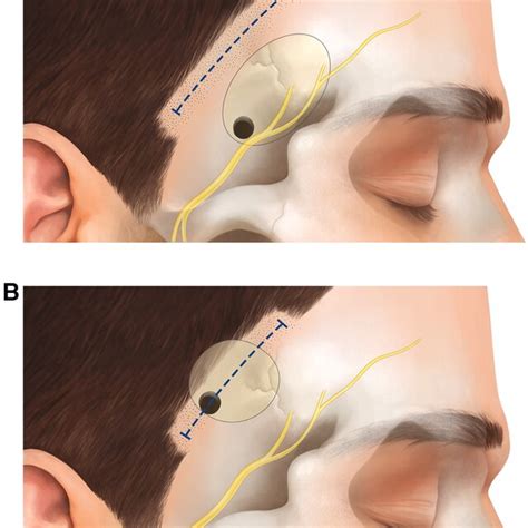 Operative Microscope Orientation And Head Rotation For The A Mpt And