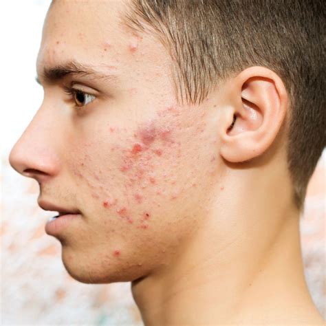 How To Treat Scars Caused By Cystic Acne Forces Of Nature Medicine