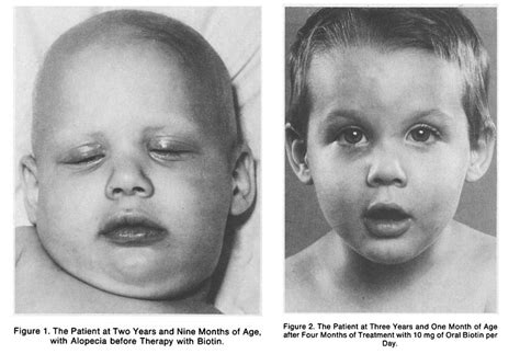 When High Dose Biotin Is Truly Needed