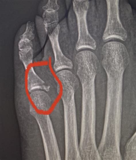 Broken 5th Phalanx Dr Didnt Catch It Will Buddy Taping Help This