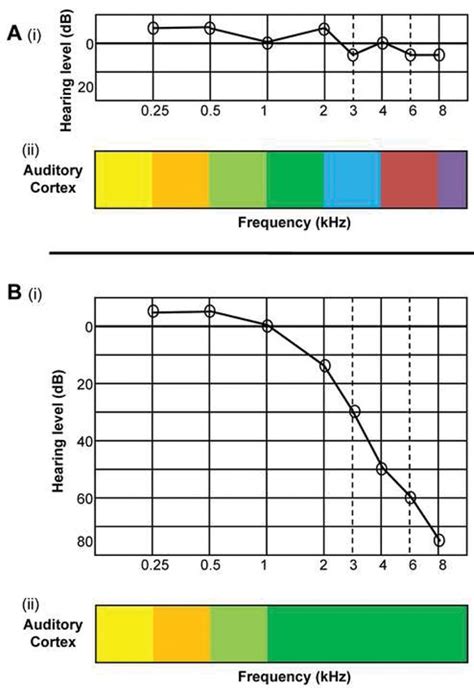 What Does Functional Neuroimaging Tell Us About Tinnitus Ent And Audiology News