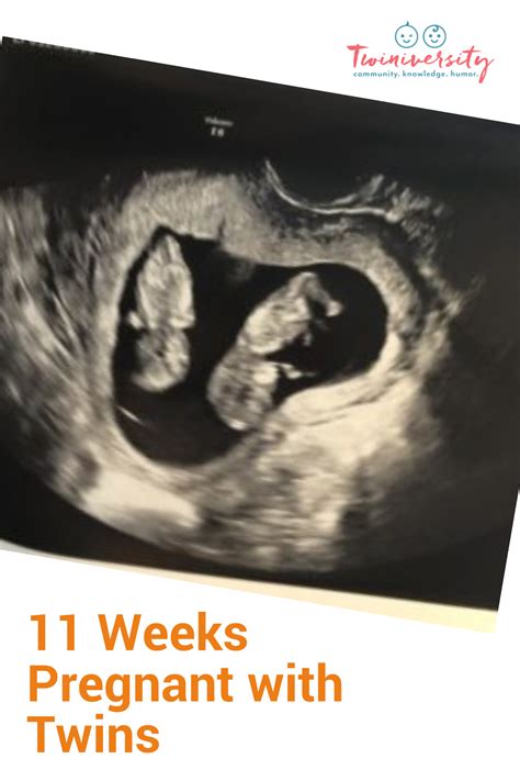 9 Weeks Pregnant With Twins Tips Advice How To Prep Artofit