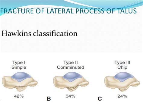 Talar Fracture