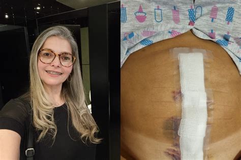 Sem Sintomas Brasileira Que Vive Na Irlanda Descobre Tumor Raro De 20 Cm Em Exames De Rotina E