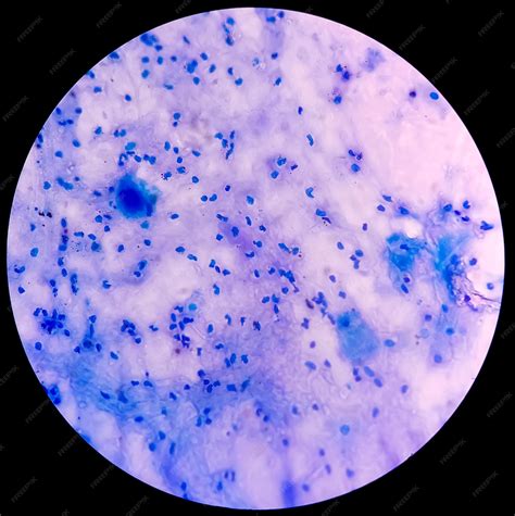 Sputum Smear