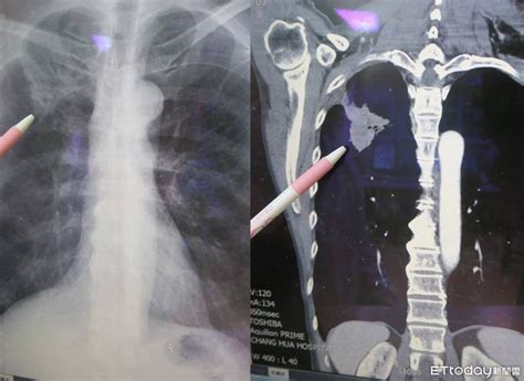 沒咳只有吞嚥卡卡 罹患肺腺癌第3期醫師點出重點 Ettoday健康雲 Ettoday新聞雲