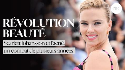 Acné De Scarlett Johansson