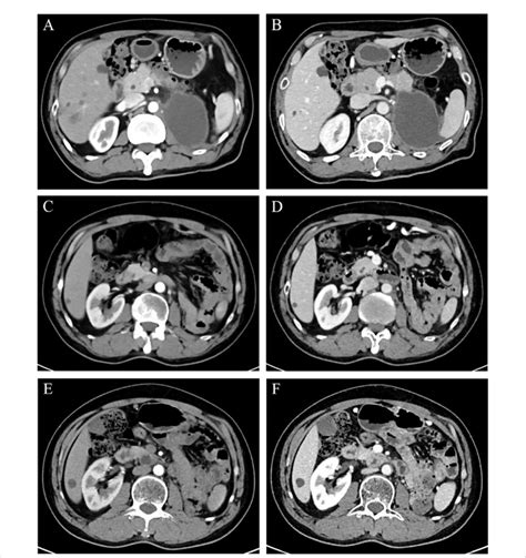 Regular Dynamic Contrast Enhanced Ct Scan Manifestations In Cmp A C Download Scientific
