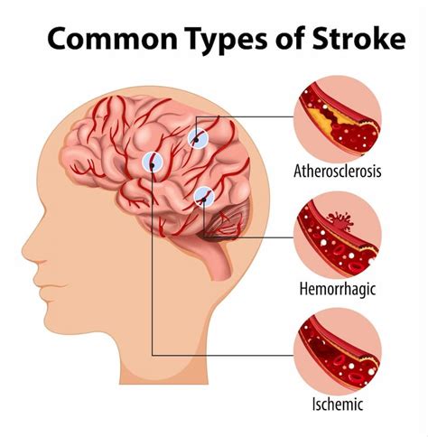 What Are The Effects Of Stroke Swiss Medica