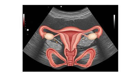 Illustration Overlaying A Sonogram Image Shows A Cross Section Of The
