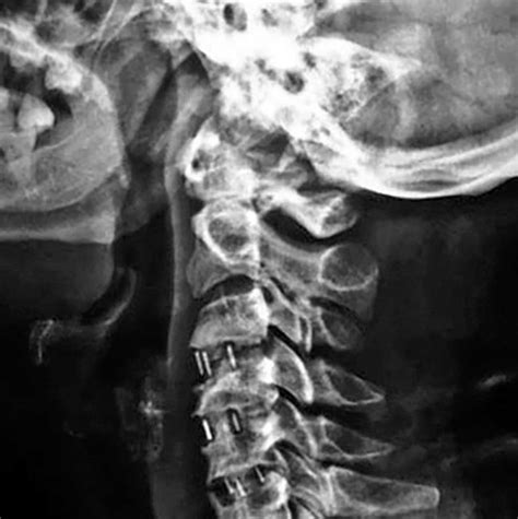 Lateral X Ray Of Cervical Spine Showing Pseudoarthrosis C3 C4 And C6 C7 Download Scientific