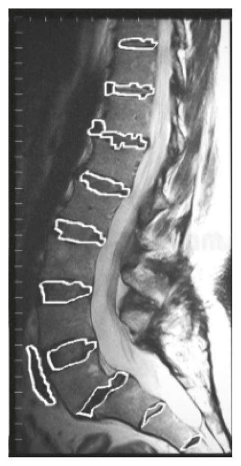 The Segmentation Image Of Improved Watershed Algorithm A Spine