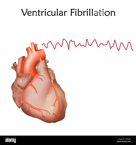 Ventricular Fibrillation Hi Res Stock Photography And Images Alamy