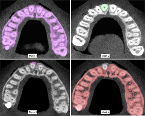 Segmentation Of The Dental Structures Using Threshold And Boolean