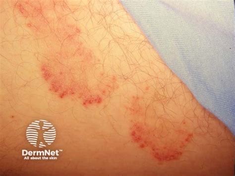 Tinea Cruris Escrotal Ringworm Tinea Corporis Patientenfolder