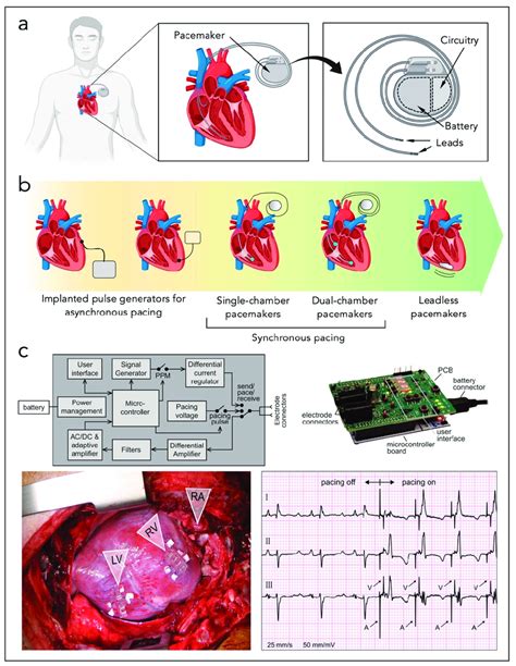 A Illustration Of A Standard Pacemaker With Indication Of The Space