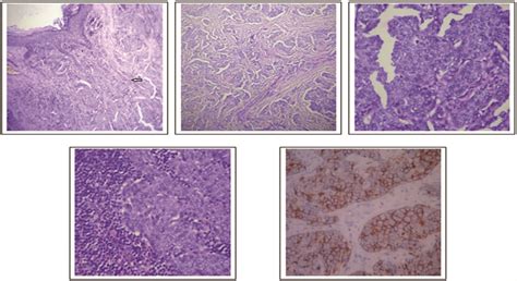 Summary Of Eccrine Porocarcinoma Cases In Literature