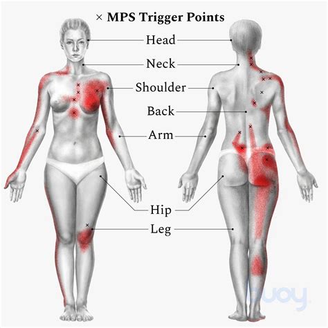 Myofascial Pain Syndrome Artofit