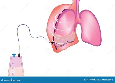 Segmentectomy Cartoons Illustrations And Vector Stock Images 2 Pictures To Download From