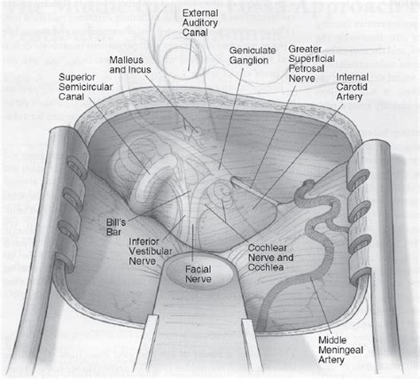 Middle Fossa Craniotomy Neupsy Key