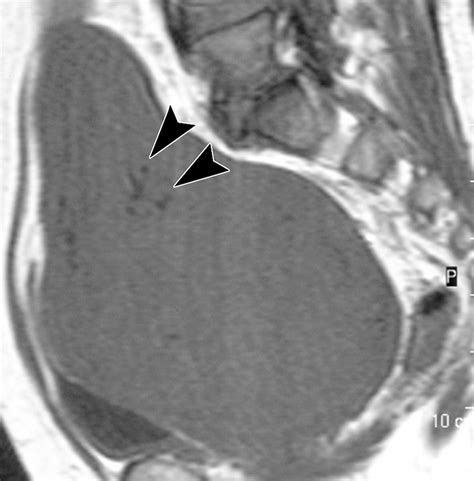 Mr Imaging Of The Uterine Cervix Imaging Pathologic Correlation