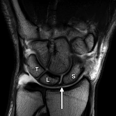 Imaging Key Wrist Ligaments What The Surgeon Needs The Radiologist To