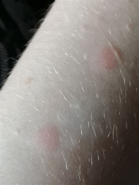 Красные пятна на теле и чешутся фото и описание