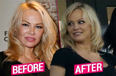 Bad Face Lifts Before After Bad Face Lifts Before After