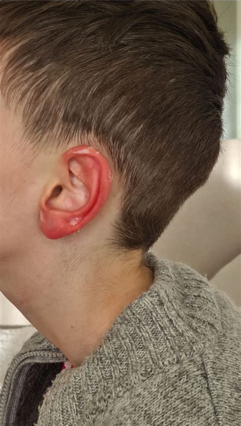 Red Colour Of A Painful Ear Red Ear Syndrome In Paediatric Age Bmj