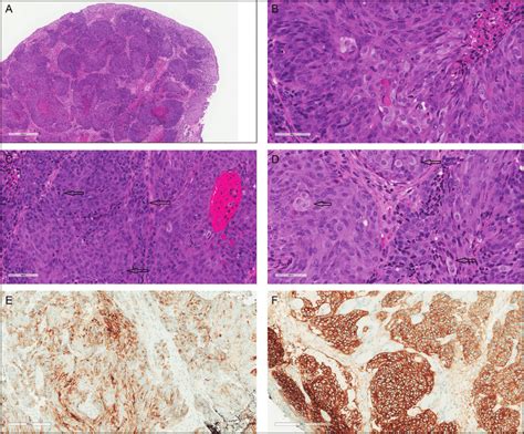The Tumor Is Composed Of Lobules Nests Of Cells Separated By A