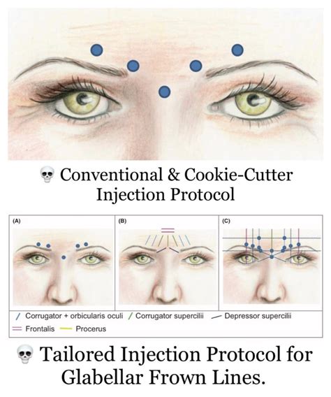 Yousef Nazari On Linkedin 💀 Neuromodulator Injection Approaches For Glabellar Contraction
