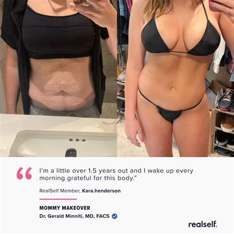 Top Plastic Surgeons Plastic Surgery Mommy Makeover Surgery Muscle