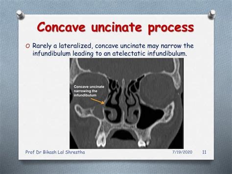 All About Uncinate Process Of Nose And Paranasal Sinuses Pptx