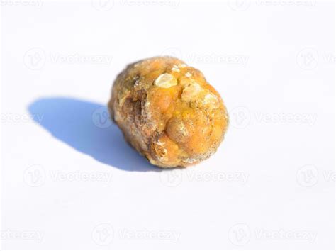 Stone Of Gallbladder The Result Of Gallstones A Calculus Of Heterogeneous Composition