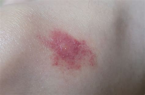 모기물림 피부발진 지식in