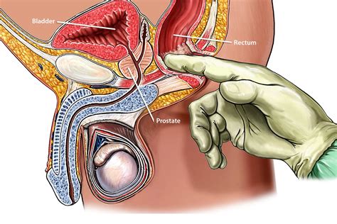 Prostate Exam Purpose Procedure And What To Expect