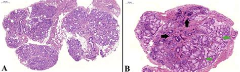 A Diffuse And B Focal Fibrosis In H E Stained Labial Salivary Download Scientific Diagram