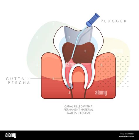Infected Teeth Root Canal Treatment Stock Illustration As Eps 10
