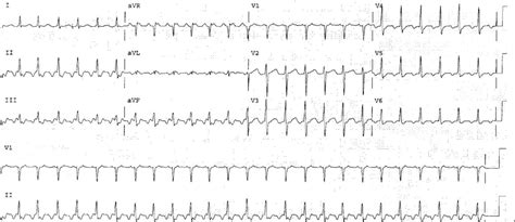 Atrial Flutter With 2 1 Conduction Manual Of Medicine