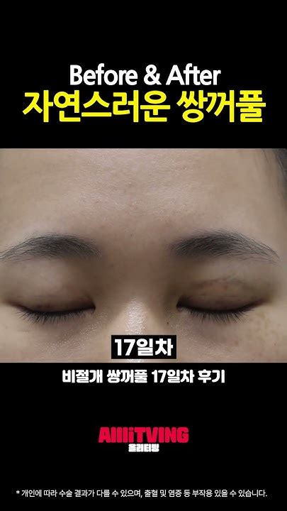 [수술전후] 자연스러운 쌍꺼풀 Youtube