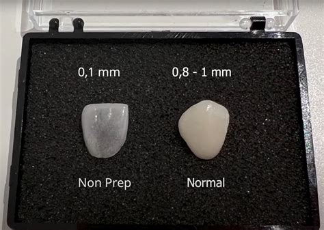 Non Prep Veneers By Innoesthetics