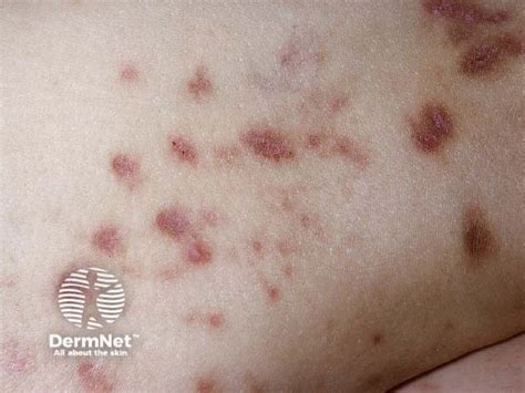 Why Diabetes Can Cause Dark Spots On Your Legs Diabetesteam