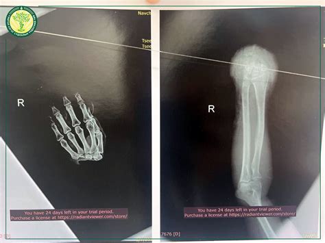 Мах зорогч машинд бугуйгаа таслуулсан өвчтөний гарыг залгах мэс засал амжилттай хийлээ