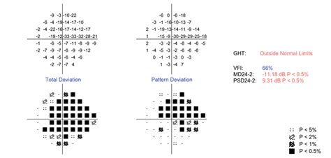 Moving Stimuli In Vf Testing May Help Diagnose Severe Glaucoma